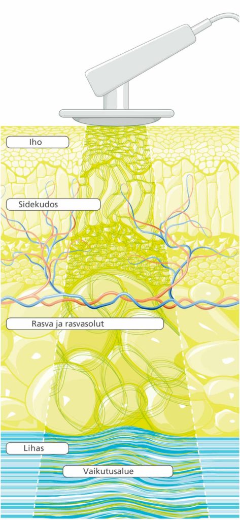 Hivamat syvävärähtelyhoito | St. Erikin Lääkintävoimistelu